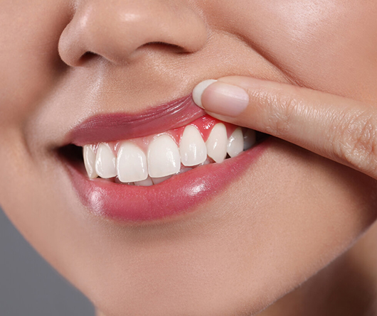 Gum Sculpting Charlotte NC | Regal Oaks Dental