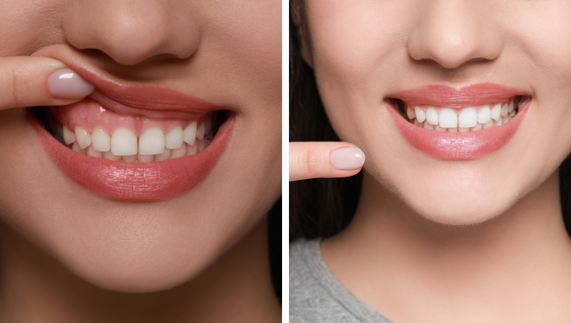 Transform Your Smile’s Frame with Gum Sculpting Today!