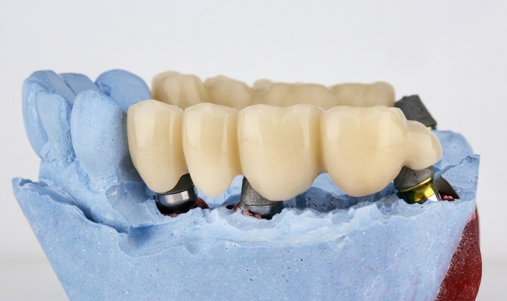 Different Types of Dental Bridges and Their Use